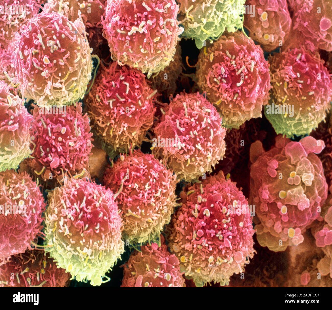 Lung cancer cells, coloured scanning electron micrograph (SEM ...