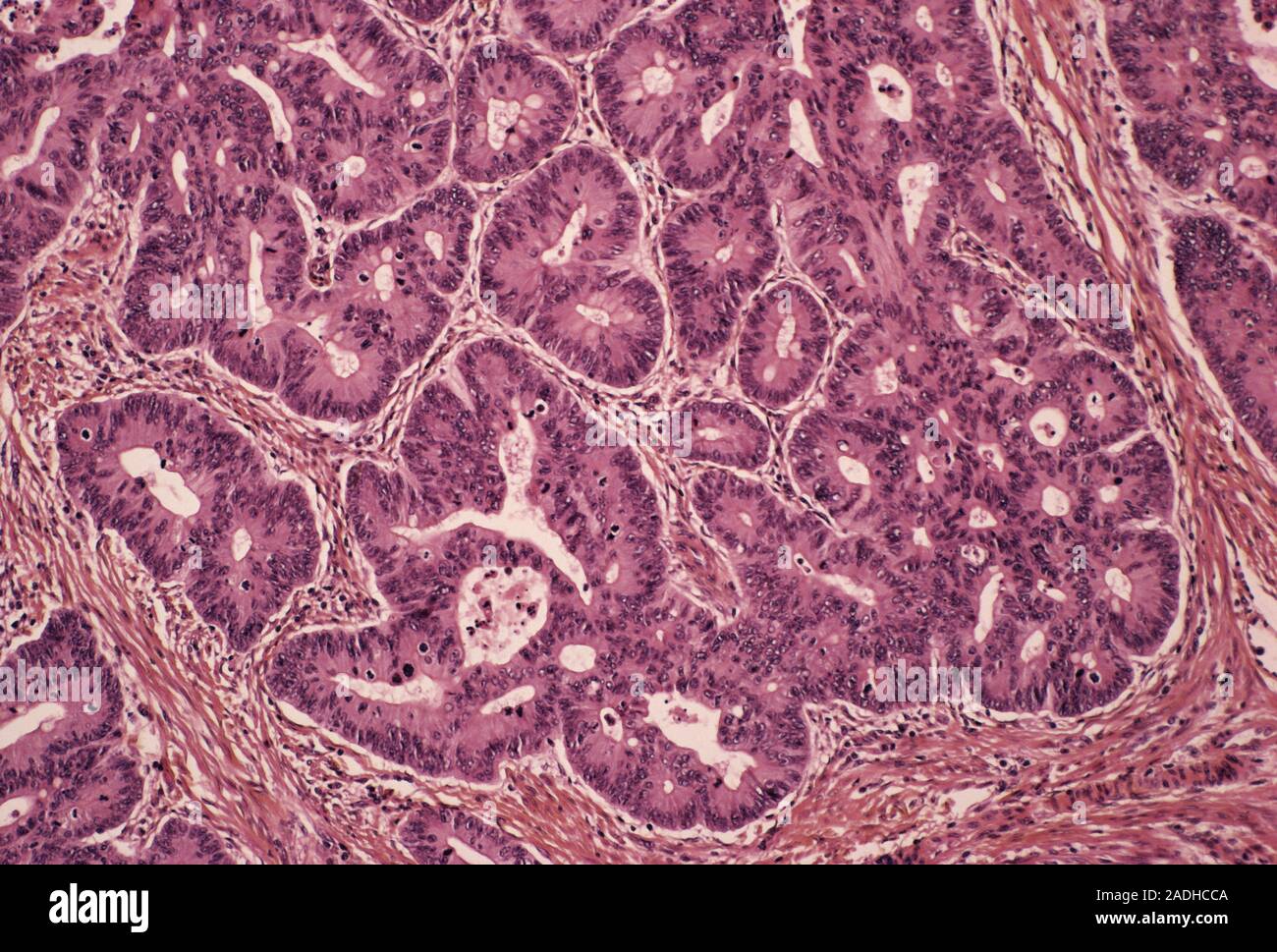 Cancerous rectal polyp. Light micrograph of a section of the rectum ...