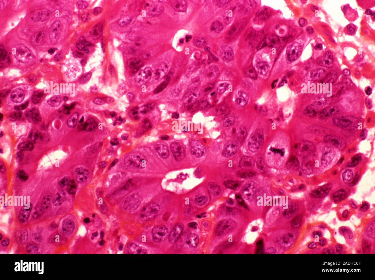 Gastric cancer. Light micrograph of a section through an adenocarcinoma ...