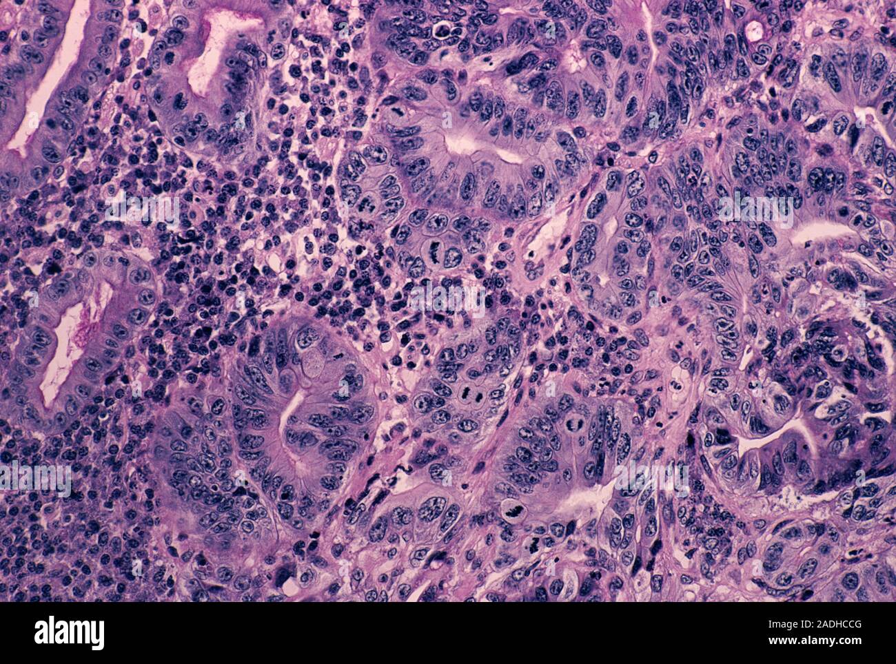 Gastric cancer. Light micrograph of a section through a gastric cancer ...