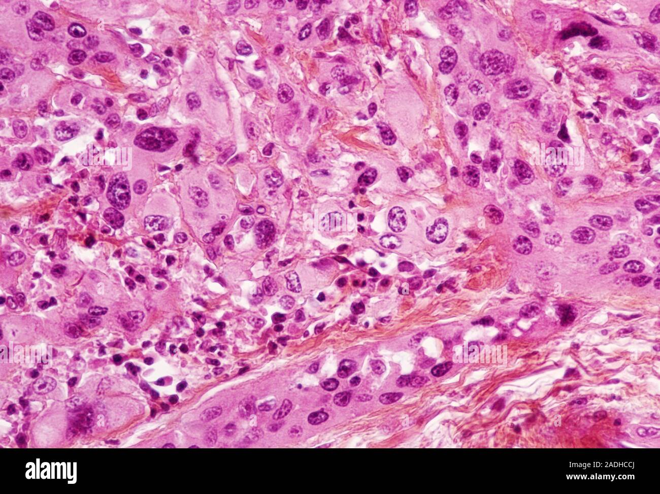 Thyroid gland cancer. Light micrograph of a section through a thyroid ...