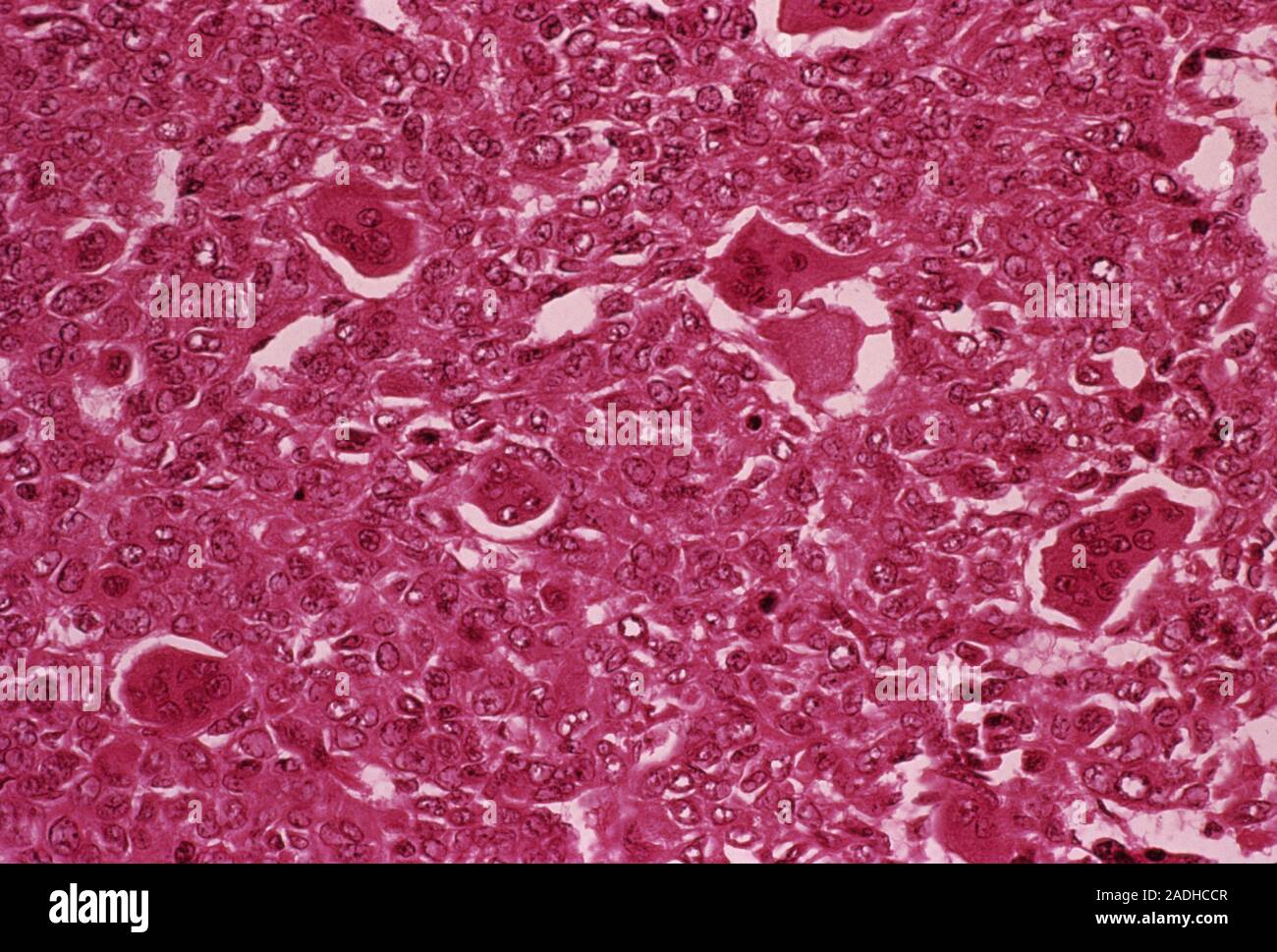 Thyroid gland cancer. Light micrograph of a section through a thyroid ...