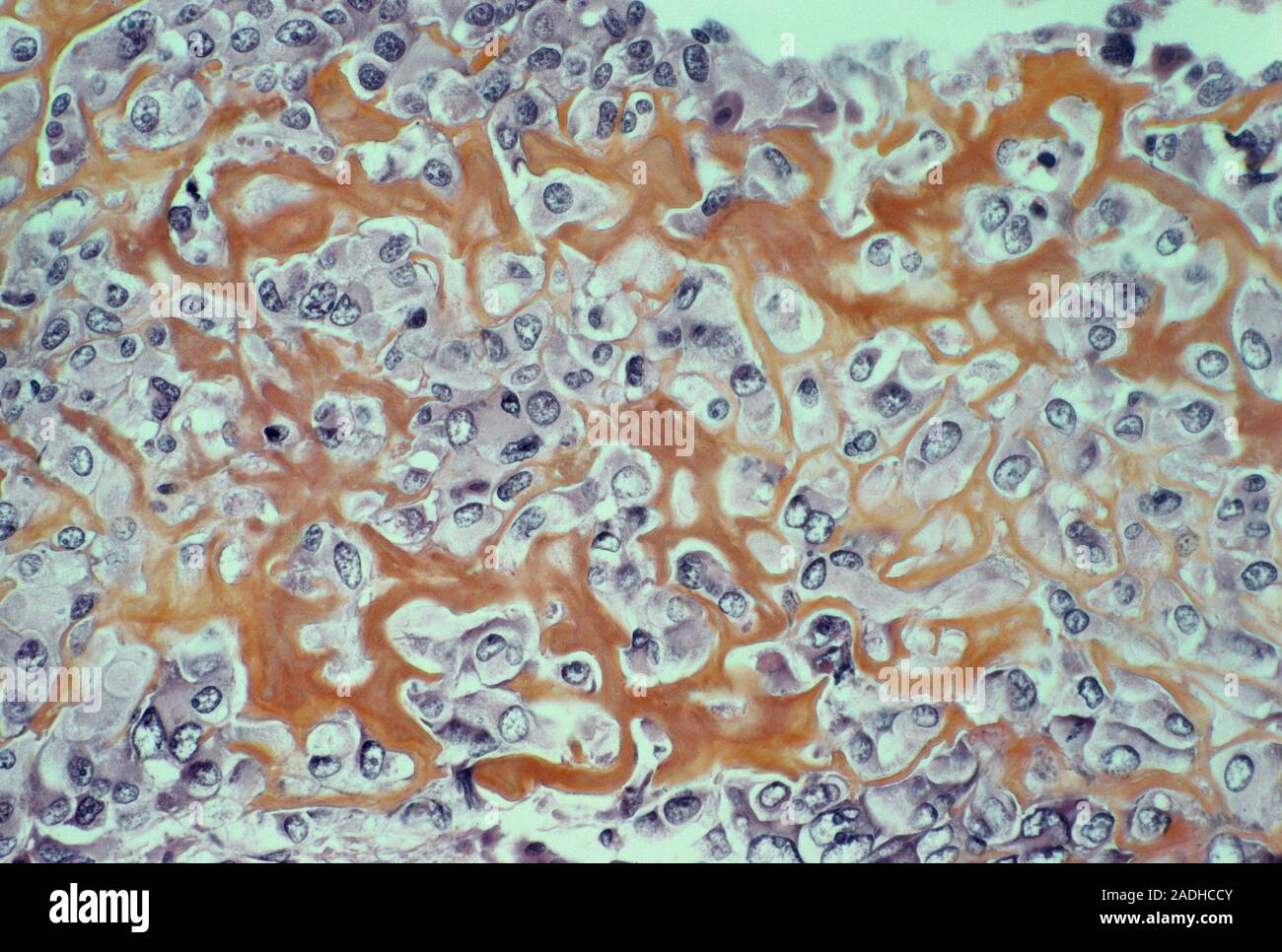 Bone cancer. Light micrograph of a section through bone revealing an ...