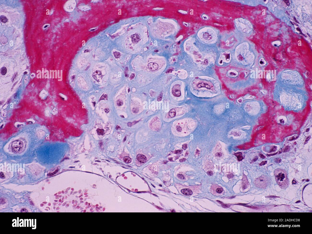 Bone cancer. Light micrograph of a section through a chondrosarcoma, a ...