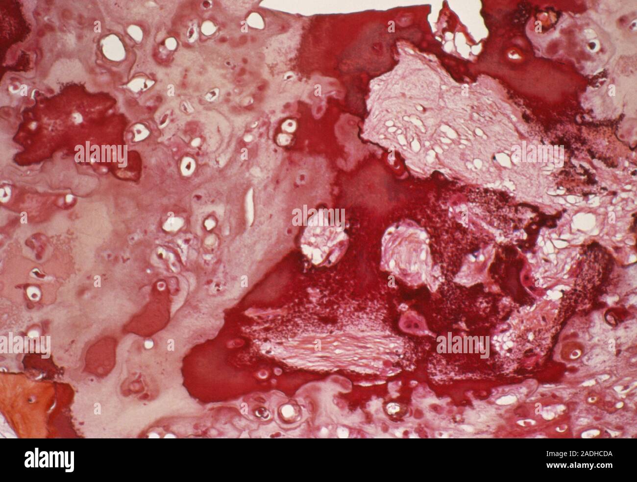 Bone tumour. Light micrograph of a section through a chondroma, a non ...