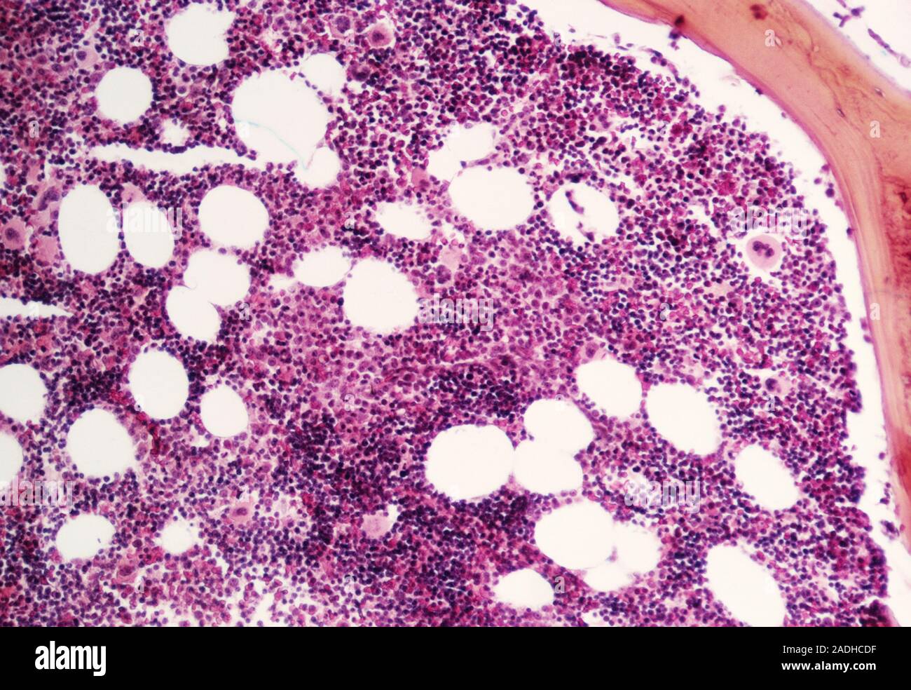 Chronic lymphoid leukaemia (CLL). Light micrograph of a section through ...