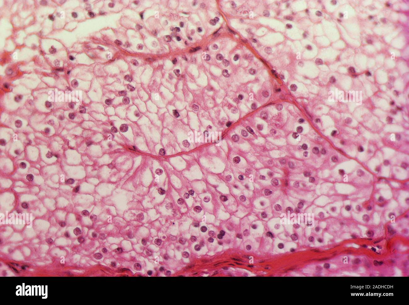 Kidney cancer. Light micrograph of a section through an adenocarcinoma ...