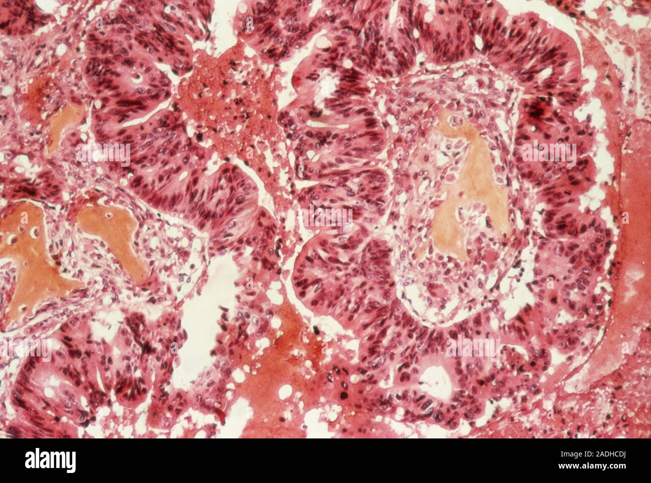 Bone tumour. Light micrograph of a section through a tumour in bone ...