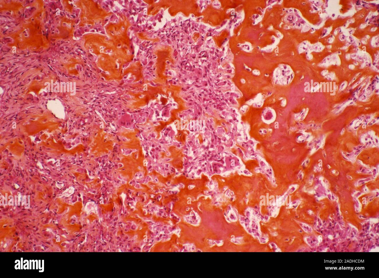 Benign bone tumour. Light micrograph of a section through a non ...