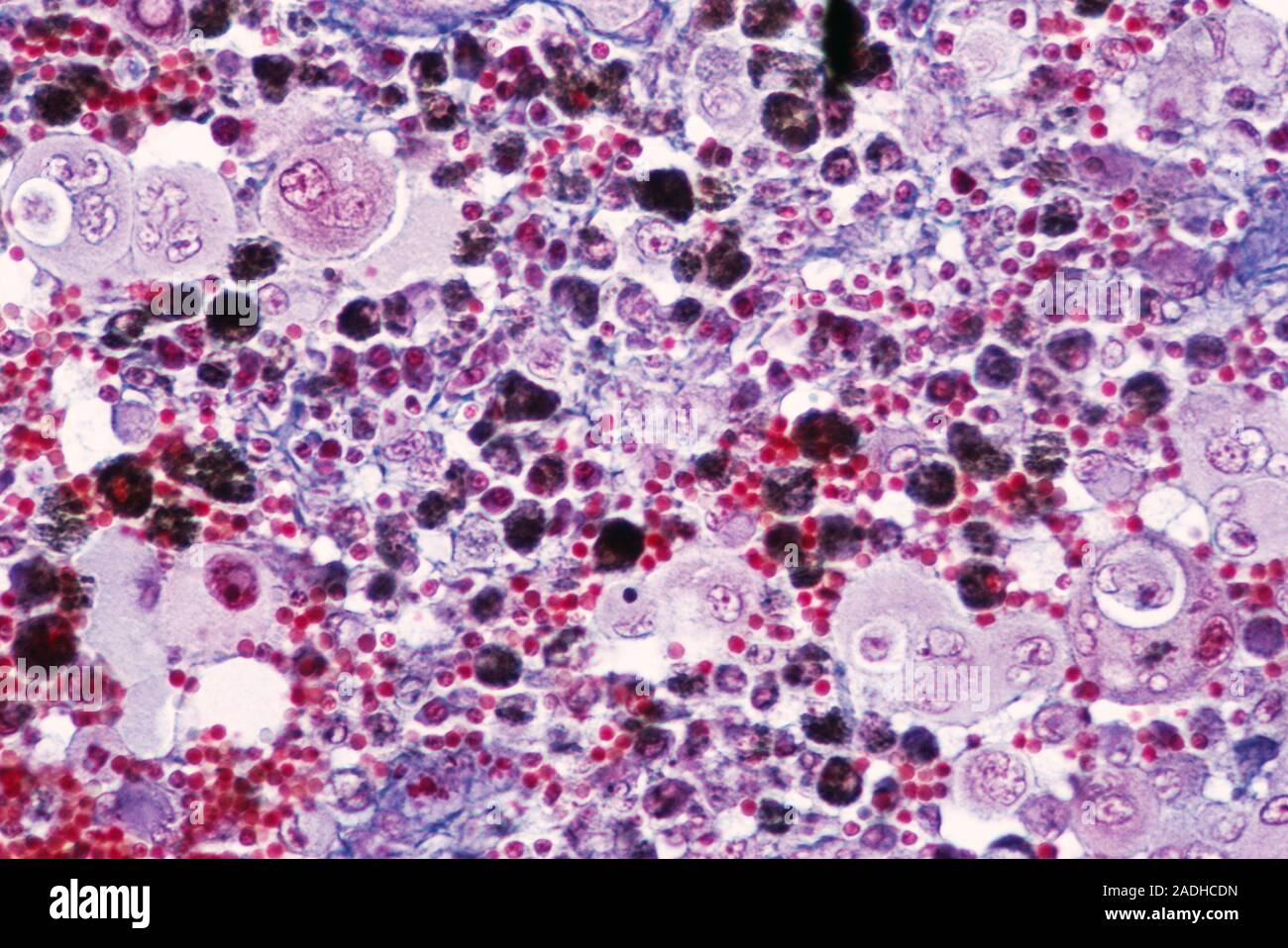 Brain tumour. Light micrograph of a section of a secondary brain tumour ...