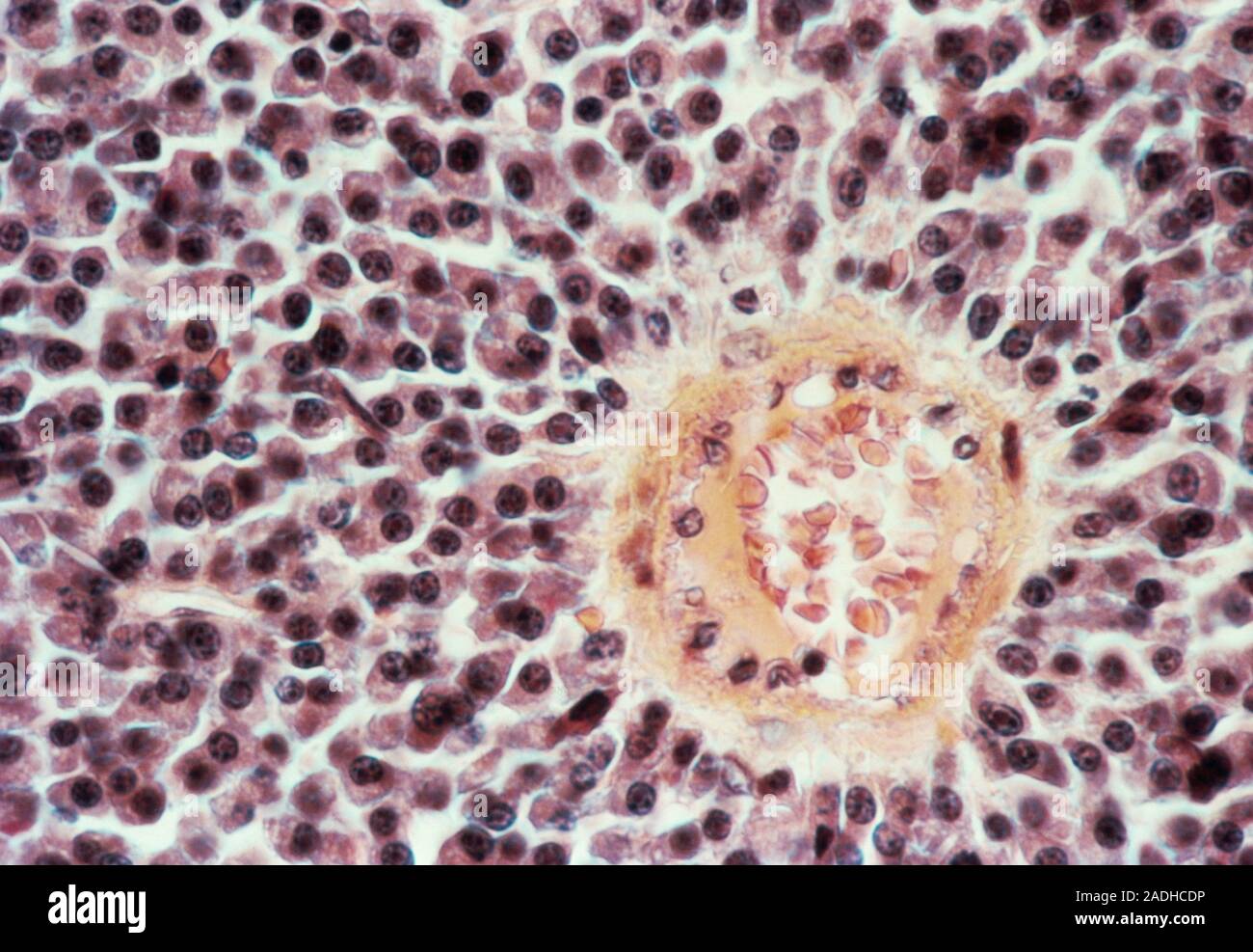 Bone marrow cancer. Light micrograph of a bone marrow cancer, myeloma ...