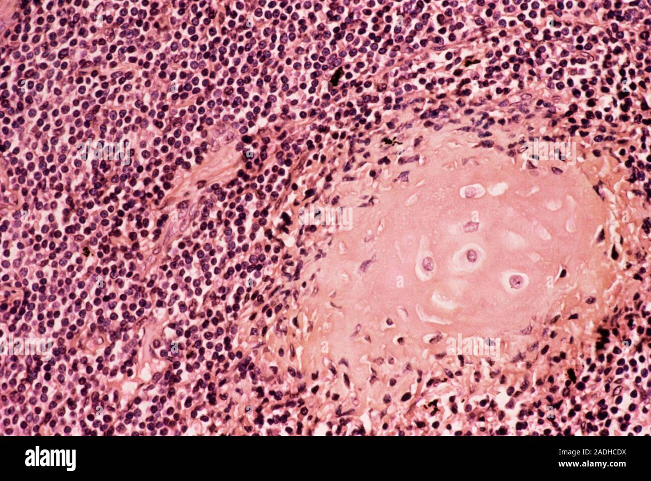 Lymphoma. Light micrograph of a section through lung tissue showing a ...