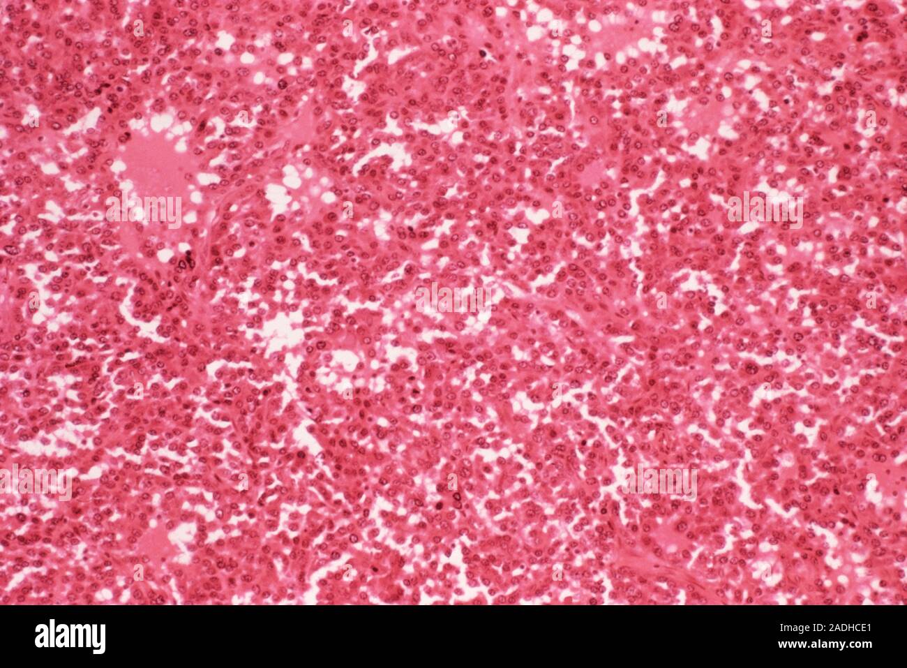Lung cancer. Light micrograph of a section through lung tissue showing ...