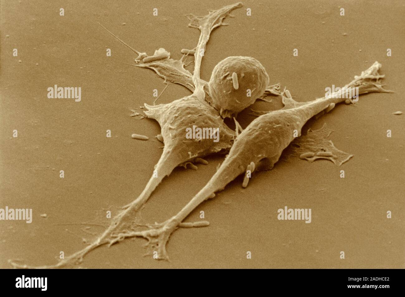 Smooth muscle cancer cells. Coloured scanning electron micrograph (SEM ...