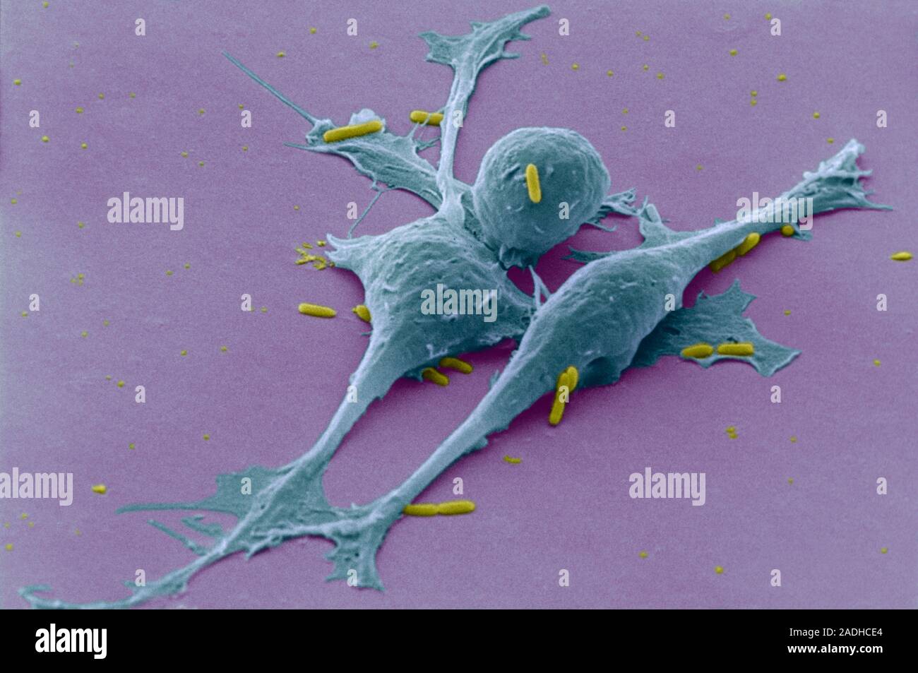 Smooth muscle cancer cells. Coloured scanning electron micrograph (SEM ...