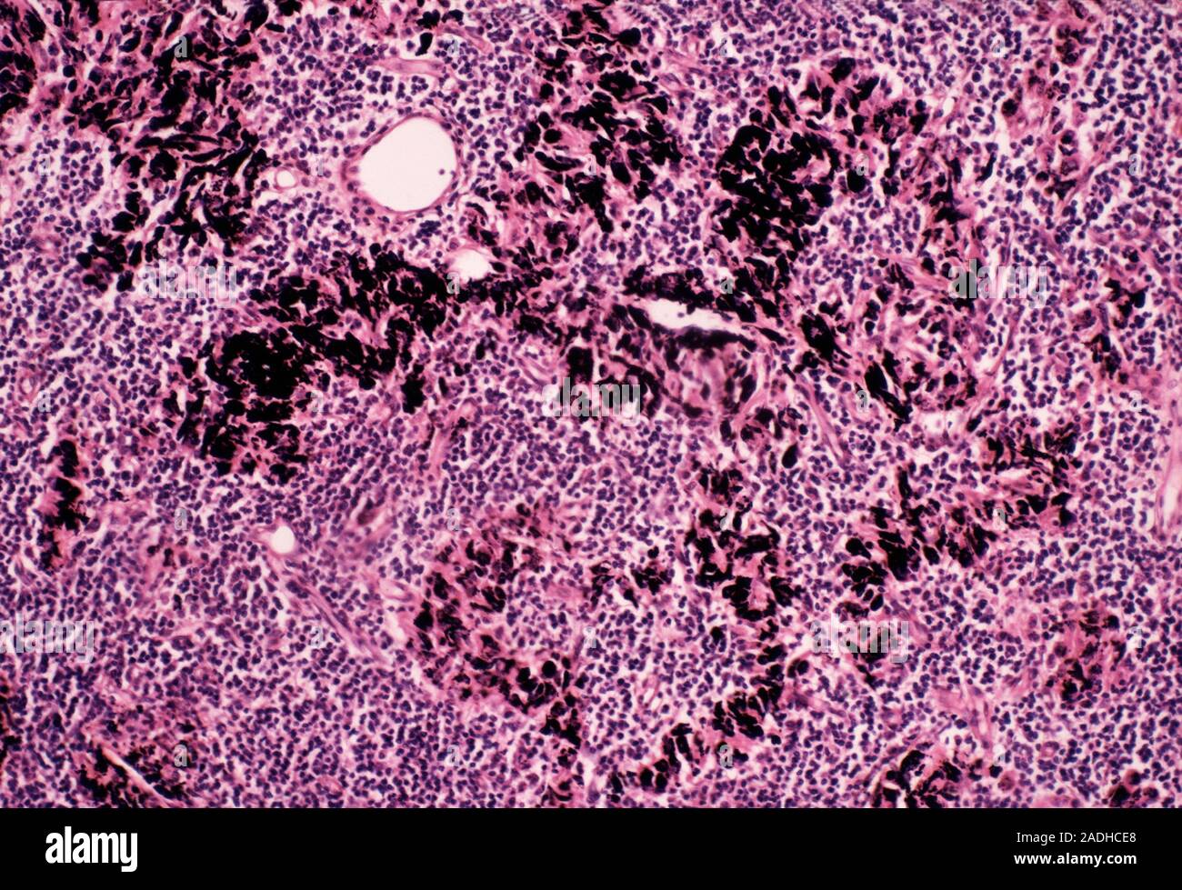 Lymphoma. Light micrograph of a section through lung tissue showing ...
