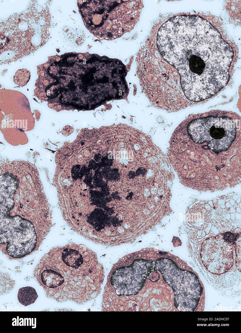 Plasmacytoma. Coloured transmission electron micrograph (TEM) of ...
