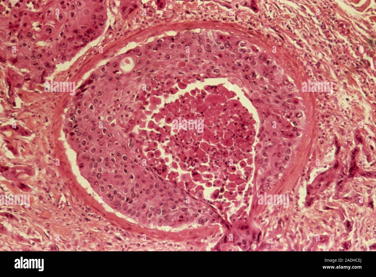 Lung cancer. Light micrograph of a section through lung tissue, showing ...