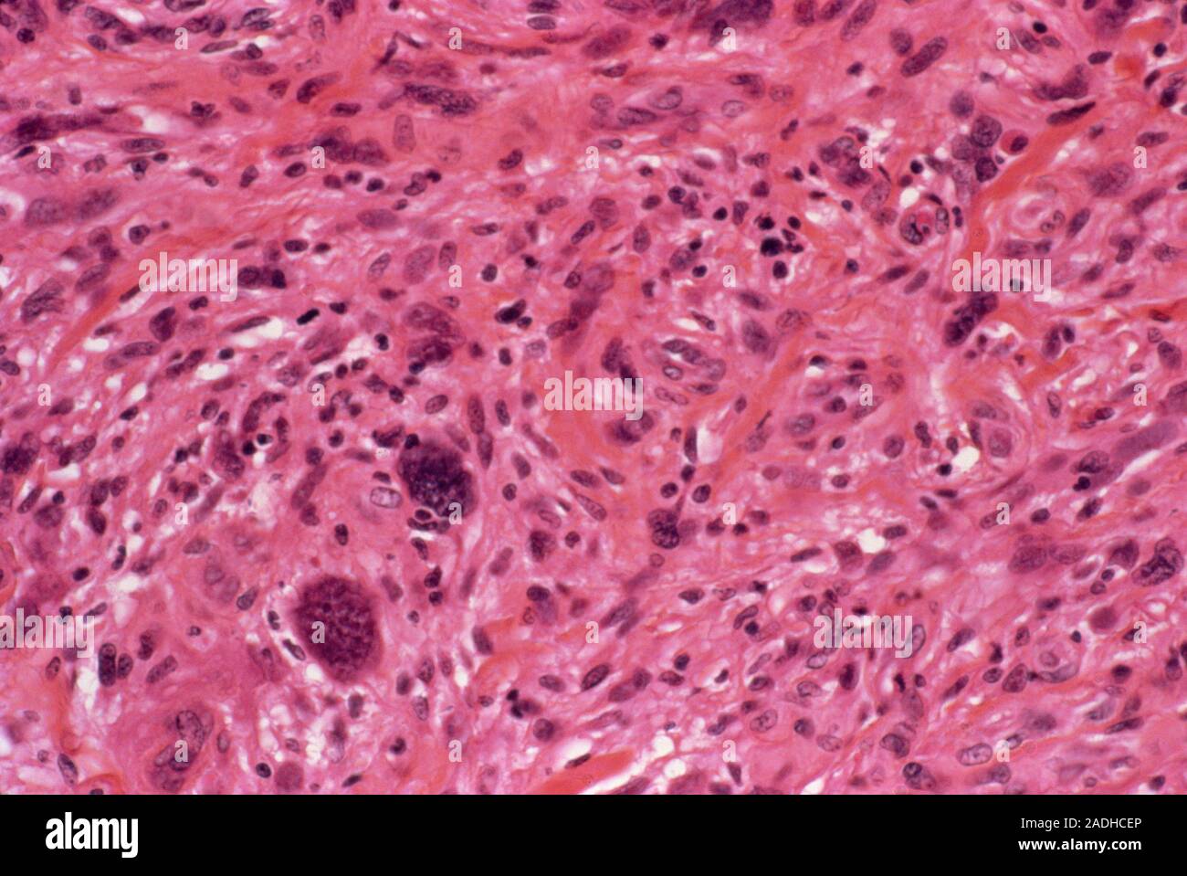 Histiocytoma cancer. Light micrograph of a section through a malignant ...