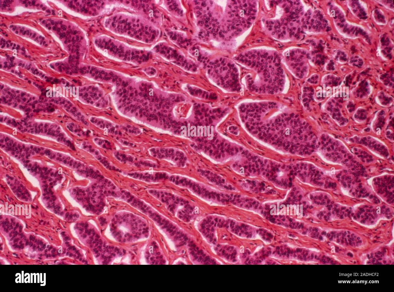 Appendix cancer. Light micrograph of a section through a carcinoid ...
