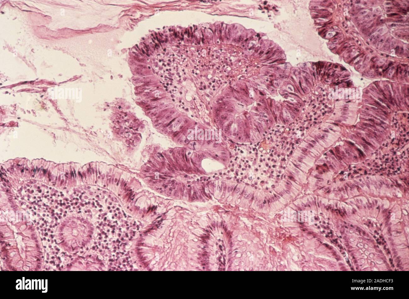 Colon cancer. Light micrograph of a section through an adenocarcinoma ...
