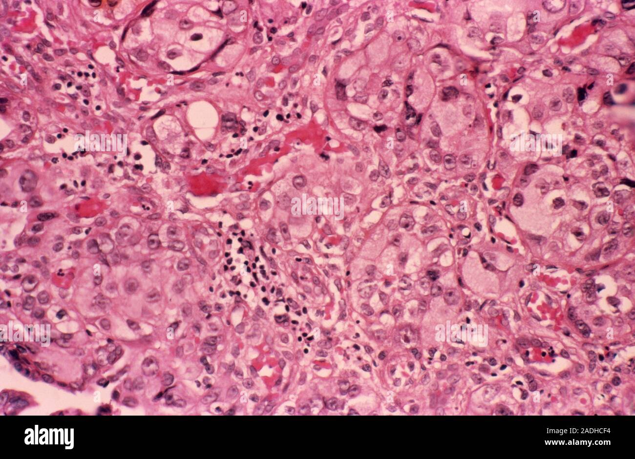 Oesophagus cancer. Light micrograph of a section through an ...