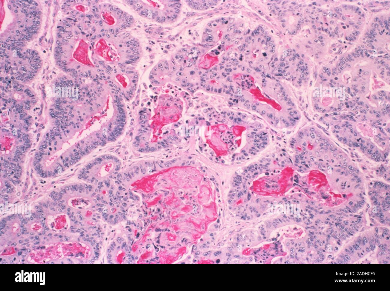 Colon cancer. Light micrograph of a slice through tissue from a ...