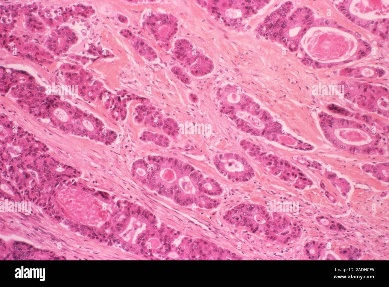 Colon cancer. Light micrograph of a slice through tissue from a ...