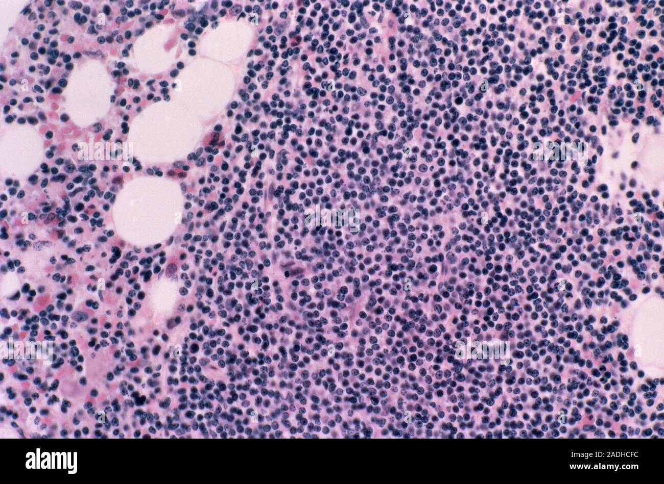 Leukaemia. Light micrograph of a section through bone marrow tissue ...