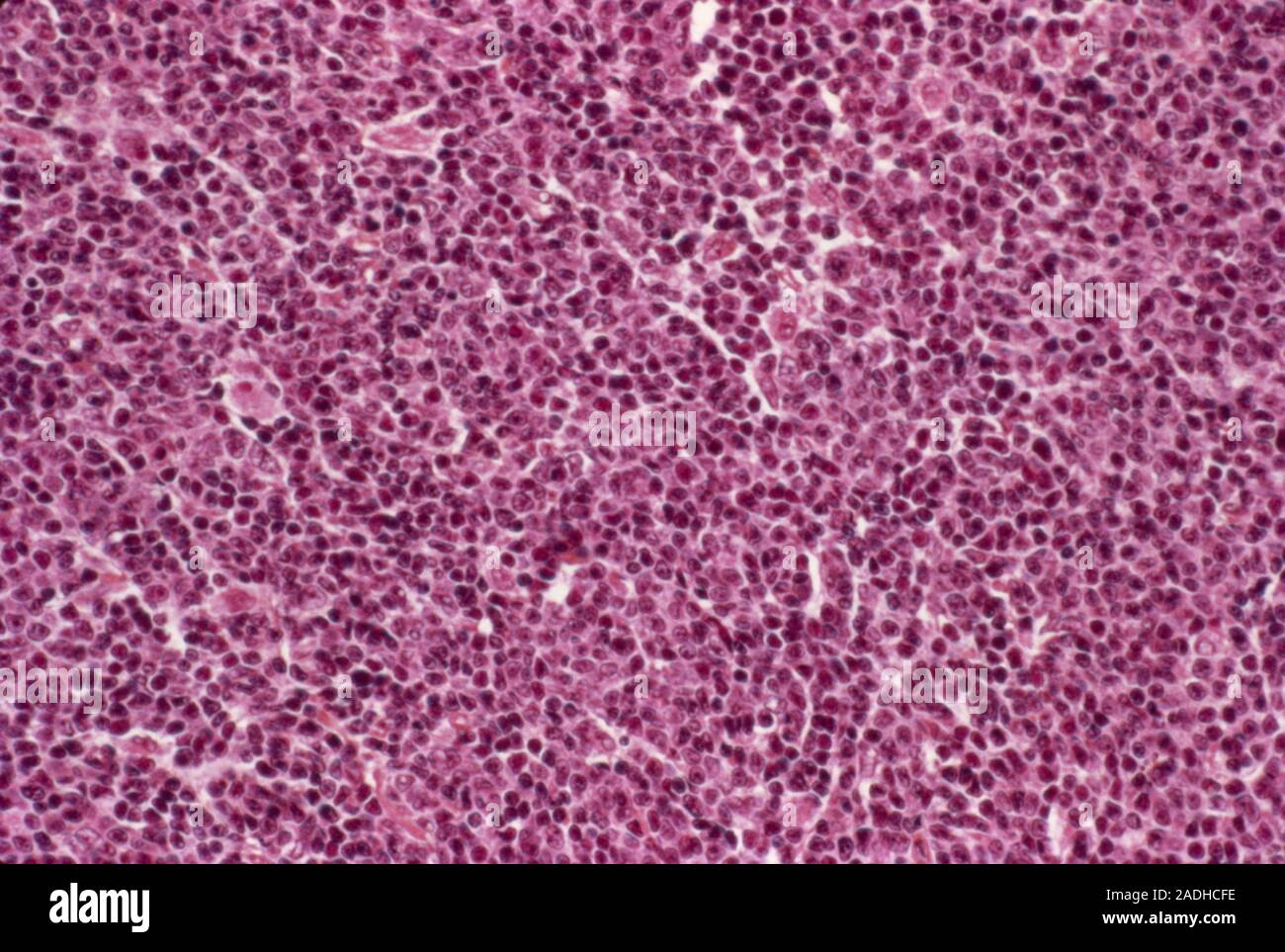 Lymphoma cancer. Light micrograph of a section through tissue from a ...