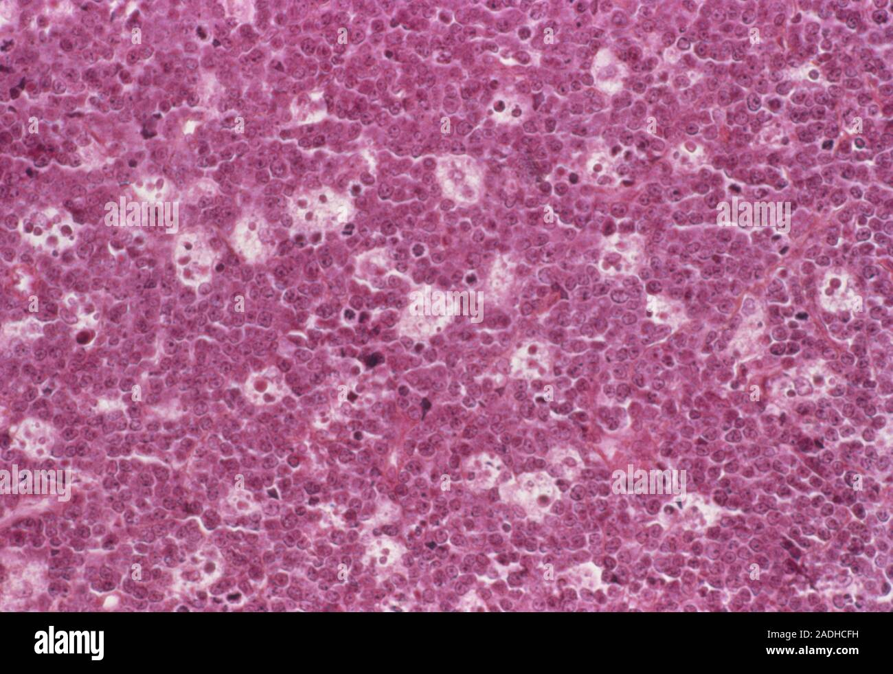 Burkitt's lymphoma cancer. Light micrograph of a section through a ...