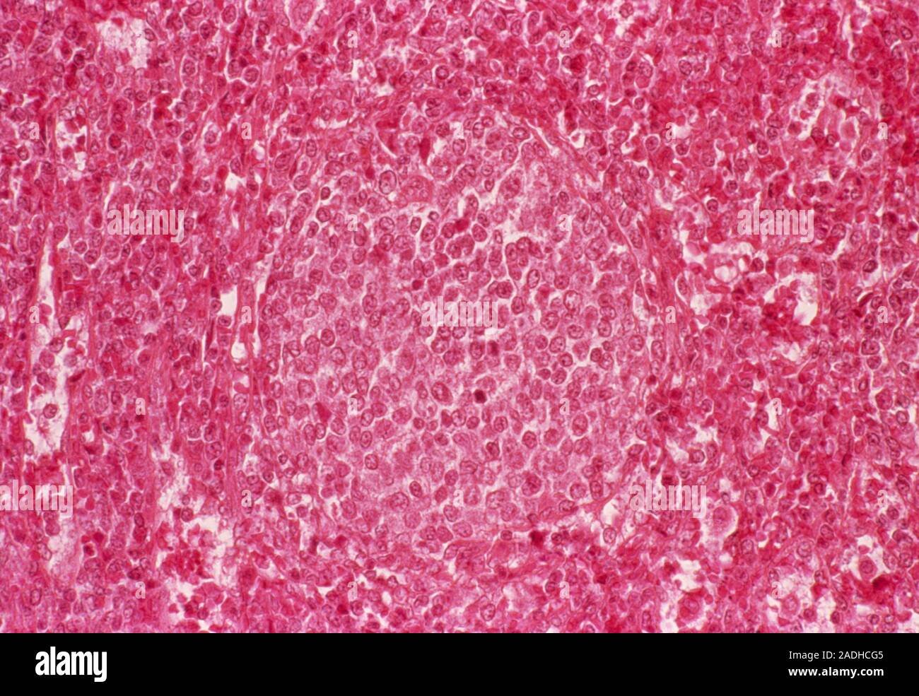 Spleen cancer. Light micrograph of a section through tissue from the ...