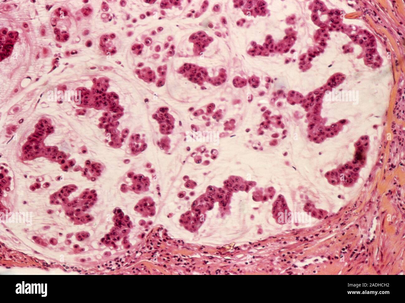 Colon cancer. Light micrograph of a section through a mucinous ...