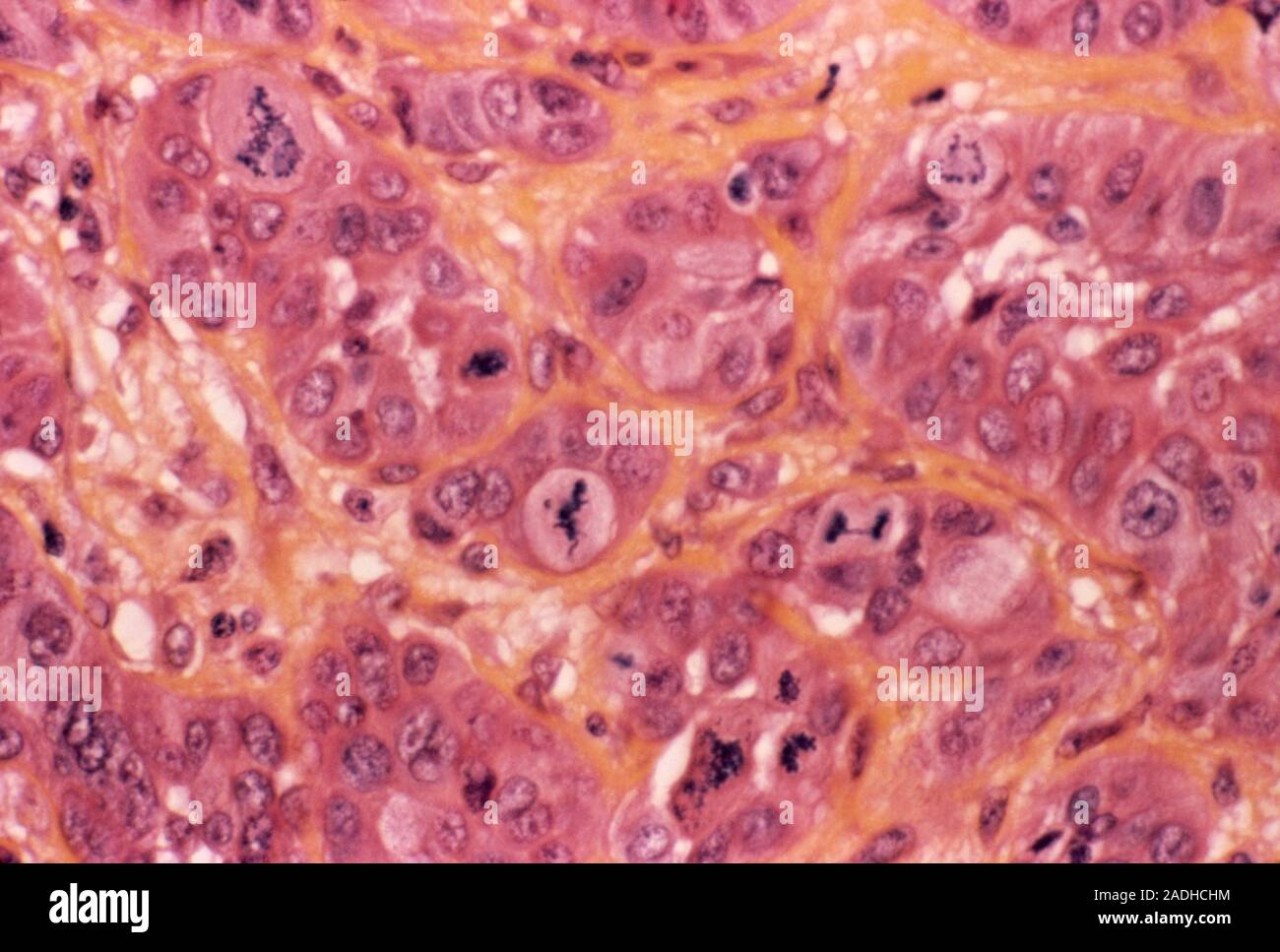 Stomach cancer. Light micrograph of a section through an adenocarcinoma ...