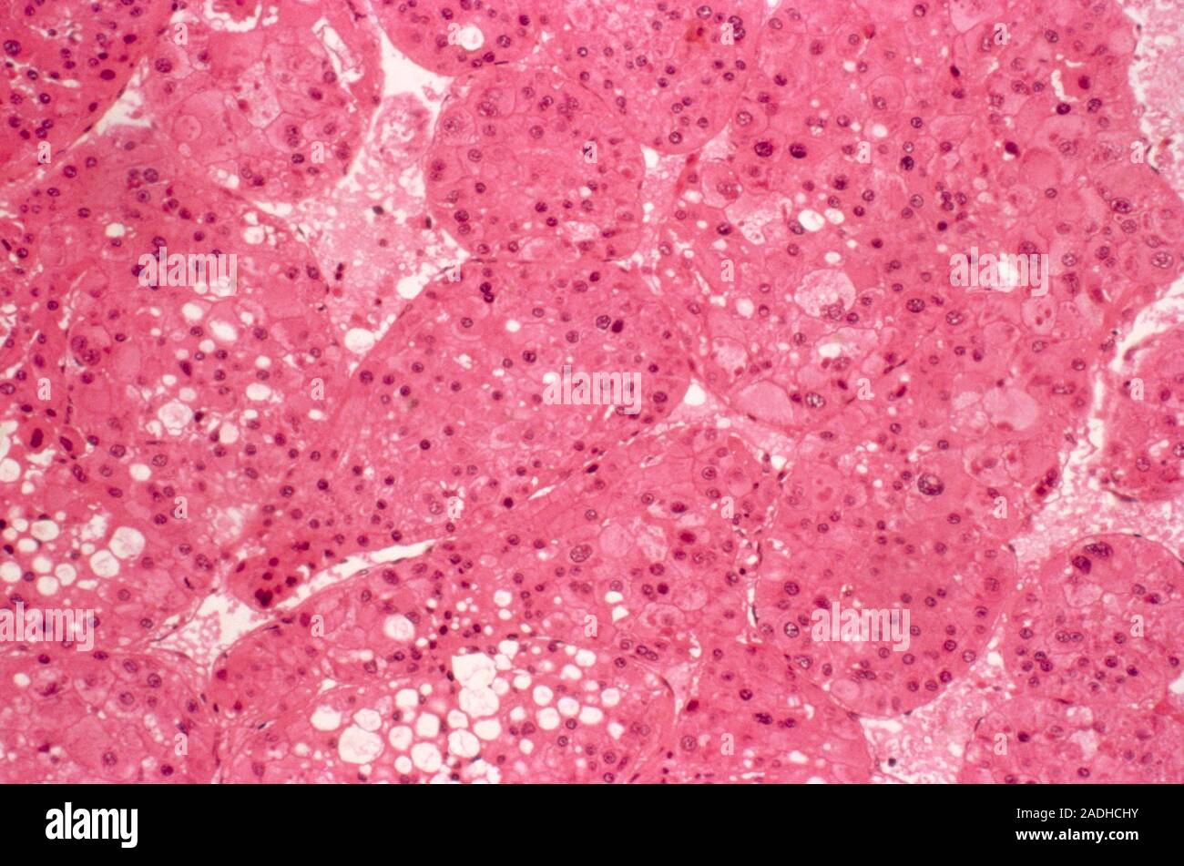 Liver cancer. Light micrograph of a slice through a primitive (early ...