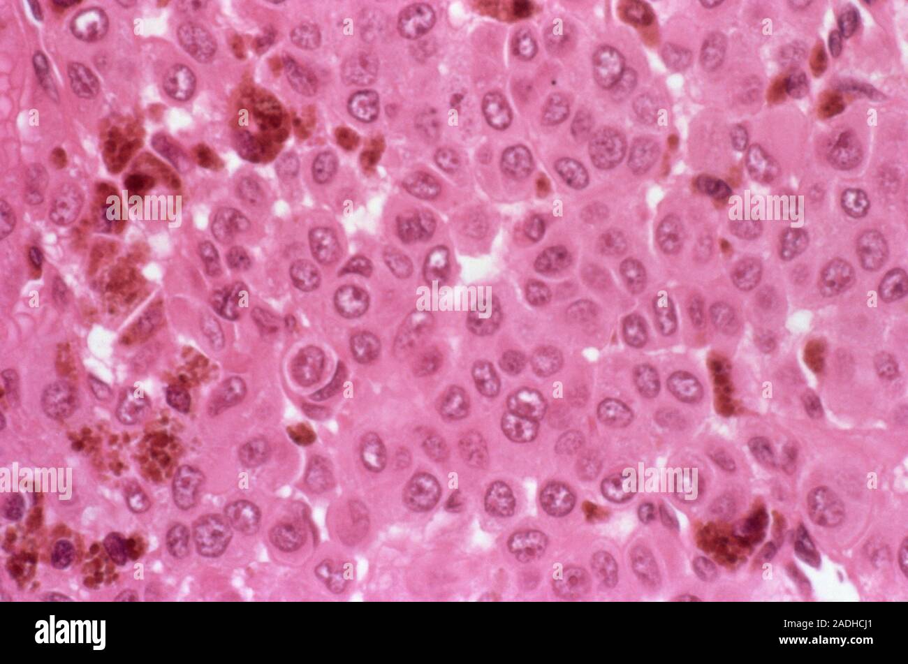 Skin cancer. Light micrograph of melanoma cancer cells, a type of skin ...