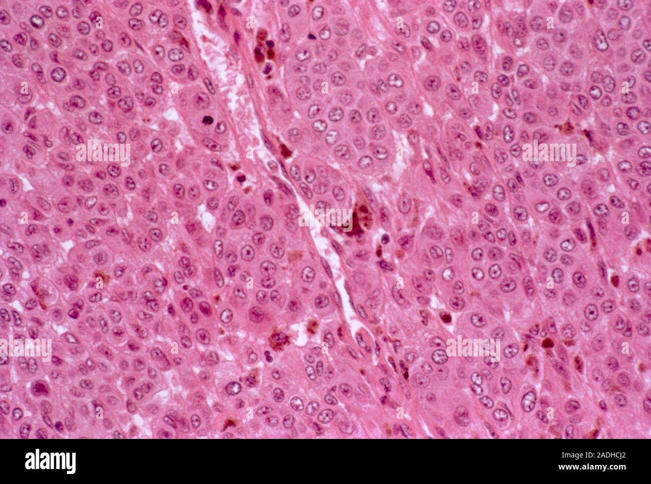 Skin cancer. Light micrograph of melanoma cancer cells, a type of skin ...