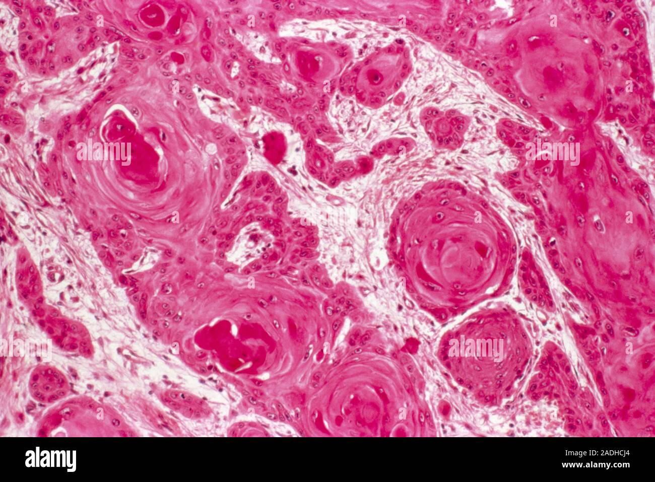 Skin cancer. Light micrograph of a section through an epidermoid ...