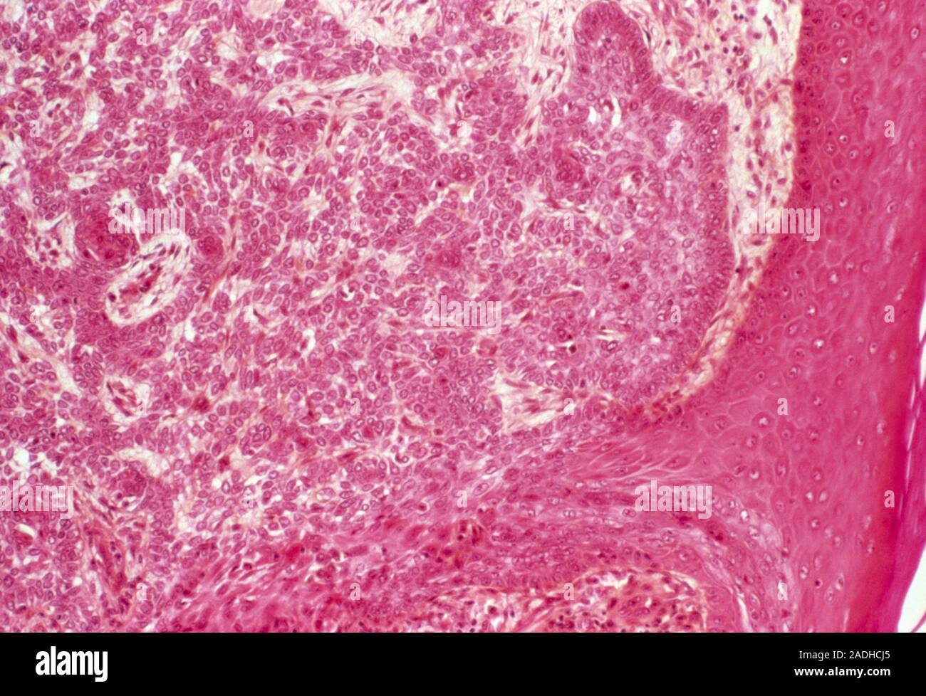 Skin cancer. Light micrograph of a section through human skin afflicted ...