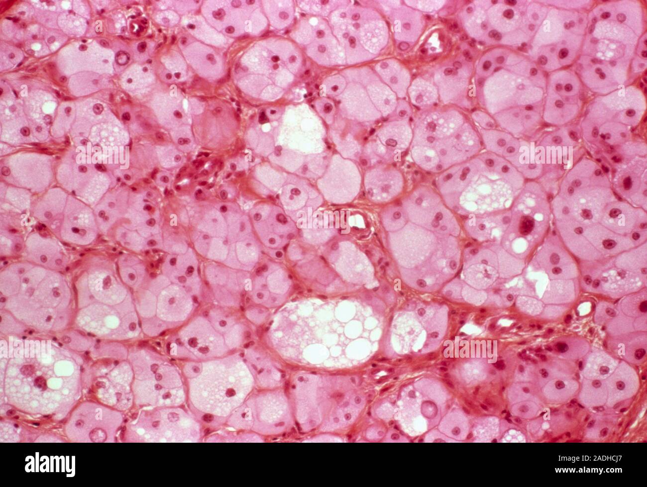 Skin cancer. Light micrograph of melanoma cancer cells in human skin ...