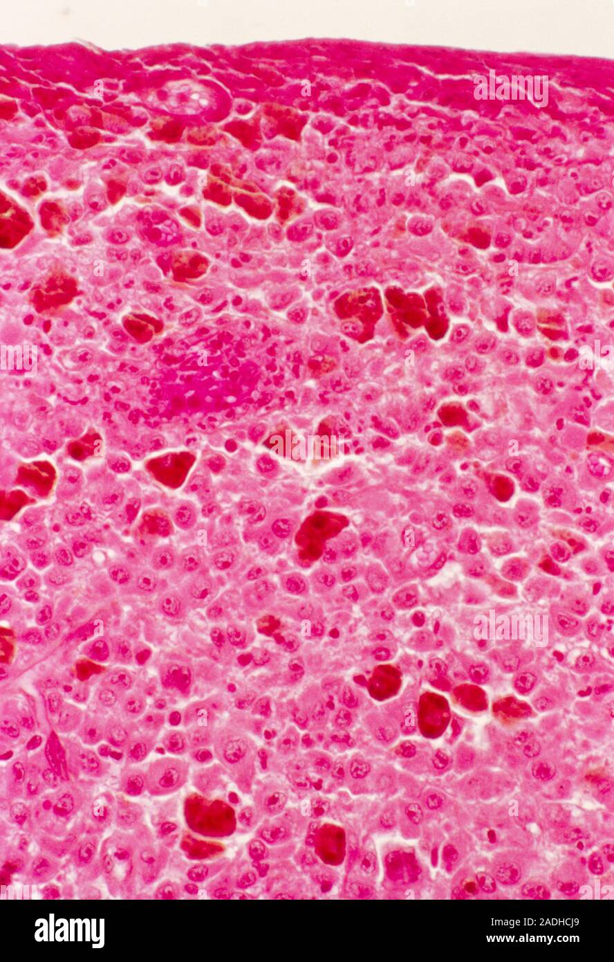 Skin cancer. Light micrograph of a section through human skin showing ...