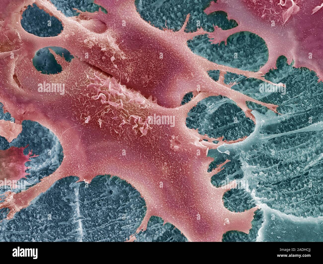 Bone cancer. Coloured scanning electron micrograph (SEM) of cancerous ...
