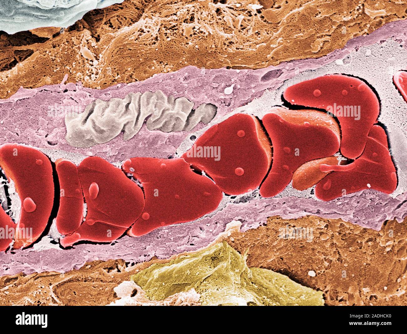 Tumour blood vessel. Coloured scanning electron micrograph (SEM) of ...