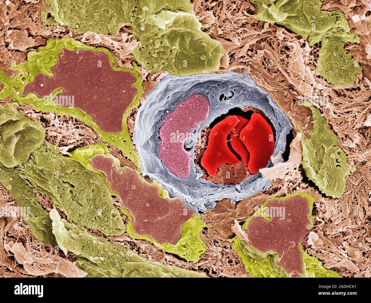 Tumour blood vessel. Coloured scanning electron micrograph (SEM) of ...