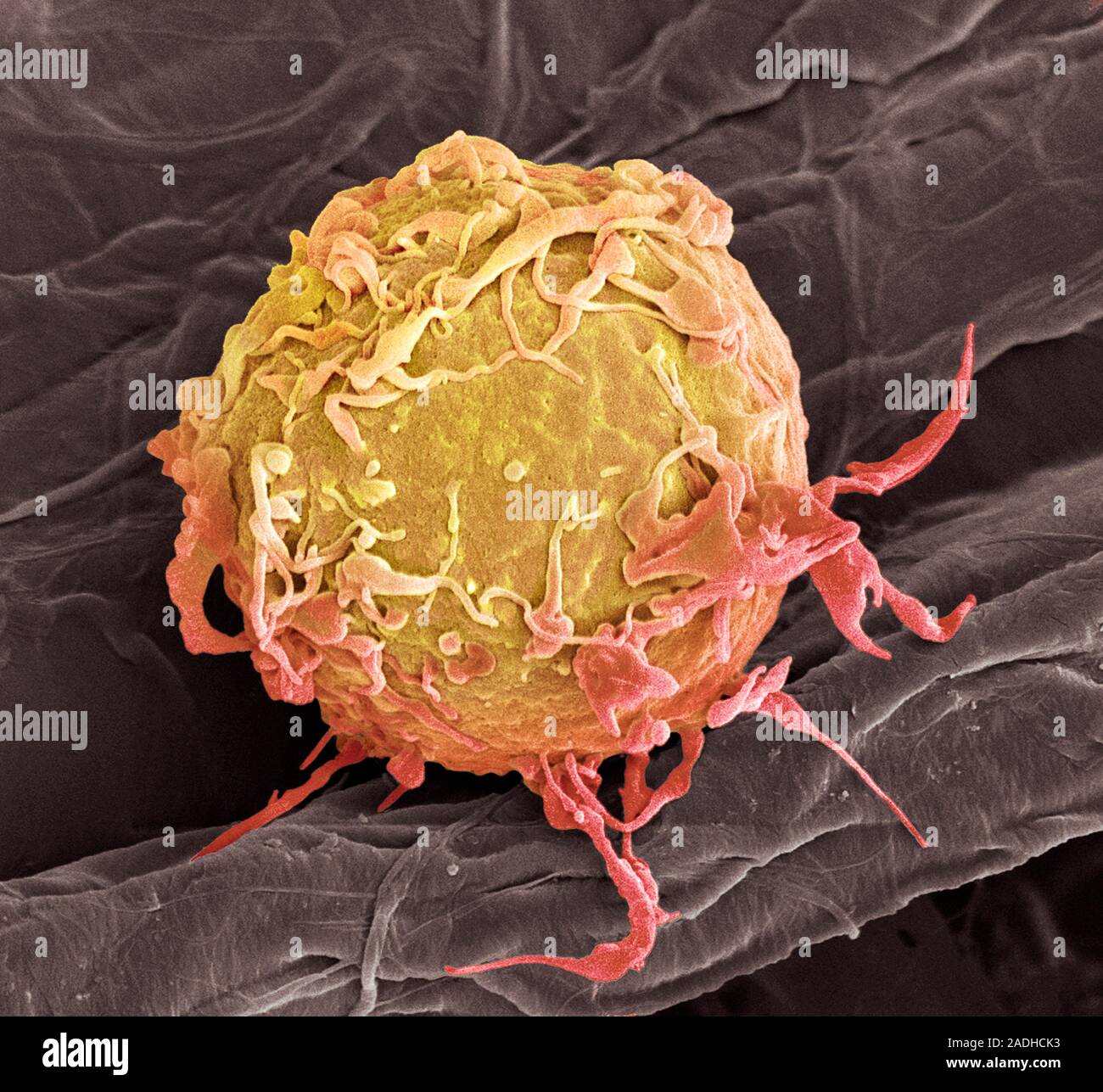 Lymphoma Cancer Cell Coloured Scanning Electron Micrograph Sem Of A Lymphoma Cell A Lymphoma