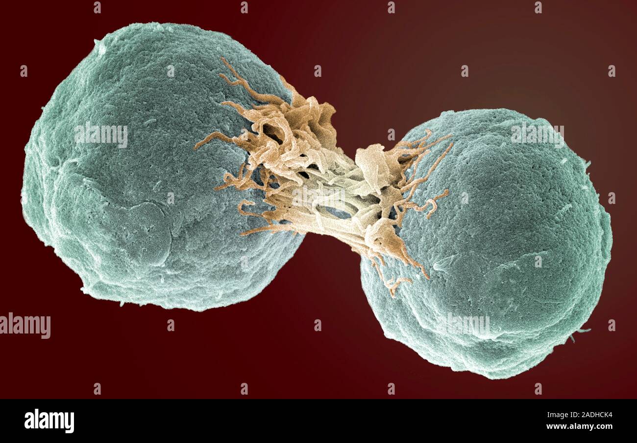 Dividing lymphoma cancer cells. Coloured scanning electron micrograph ...