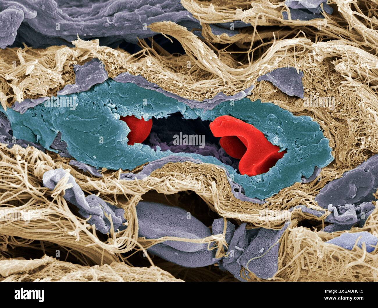 Tumour. Coloured scanning electron micrograph (SEM) of a capillary ...