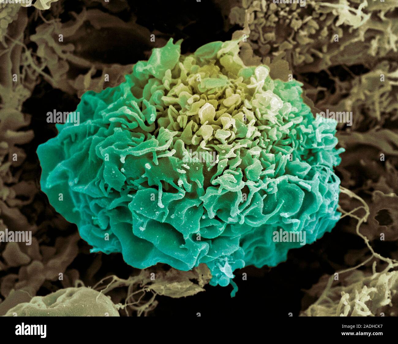 Tumour. Coloured scanning electron micrograph (SEM) of a sarcoma cancer ...