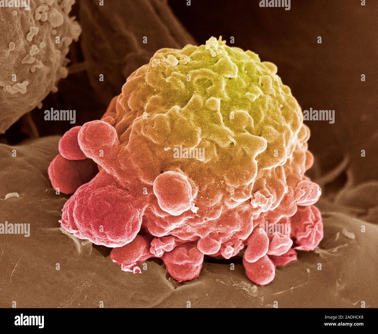 Leukaemia cell. Coloured scanning electron micrograph (SEM) of a ...
