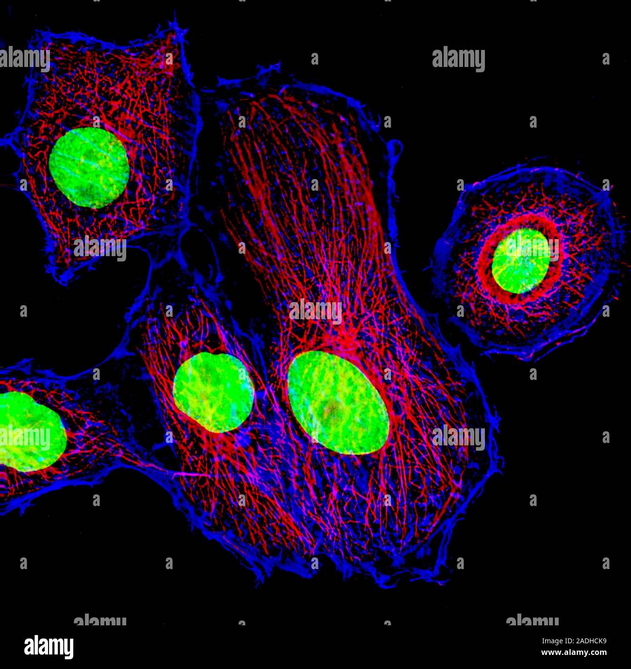 Cancer cell division. Immunofluorescent light micrograph of cancer ...